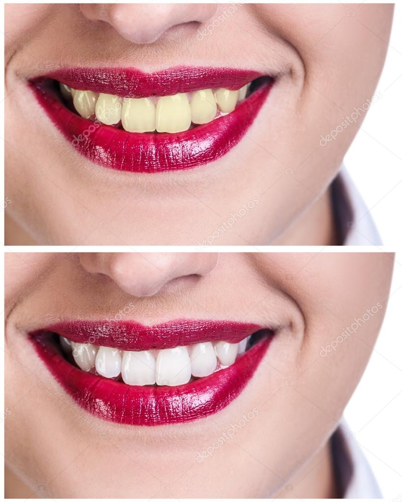 Teeth before and after bleaching treatment Stock Photo by ©kotin 114071176