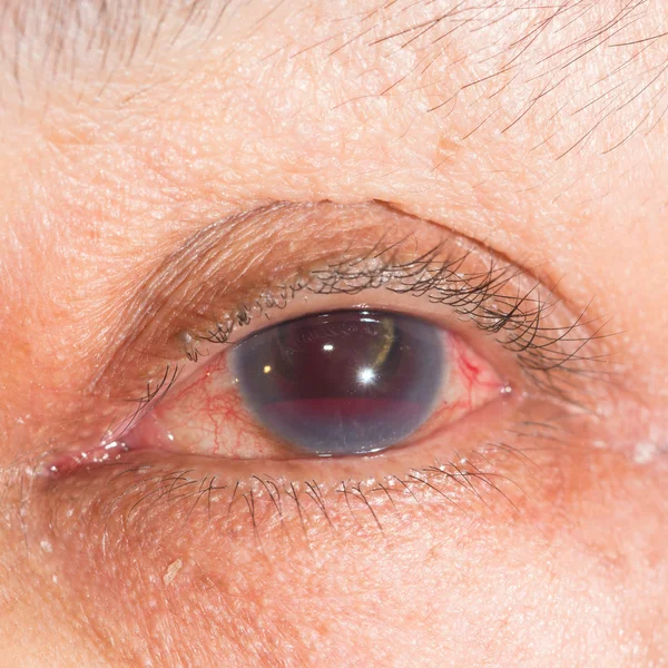 Hyphema at eye test — Stock Photo © arztsamui #105259664