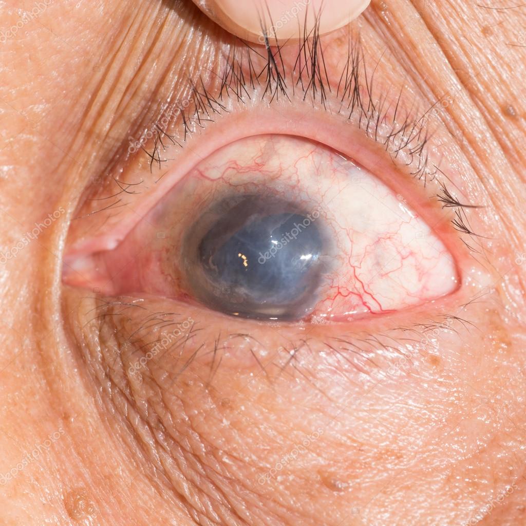 Phthisis bulbi no teste oftalmológico — Foto © arztsamui #106593348