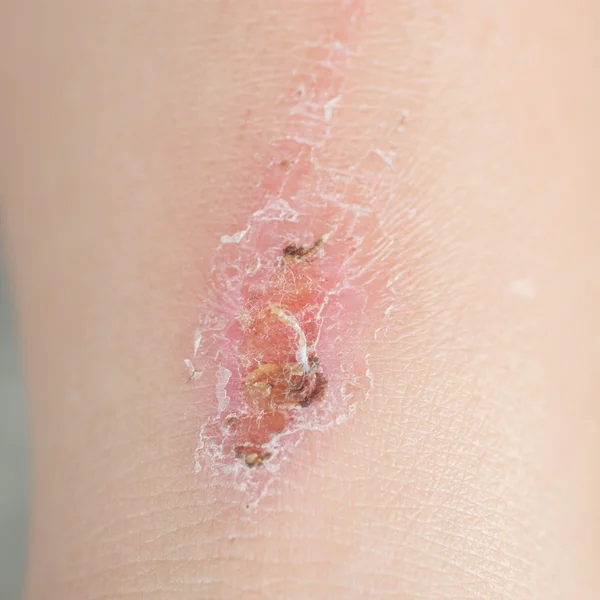 Formación de costras Stock Photos, Royalty Free Formación de costras ...