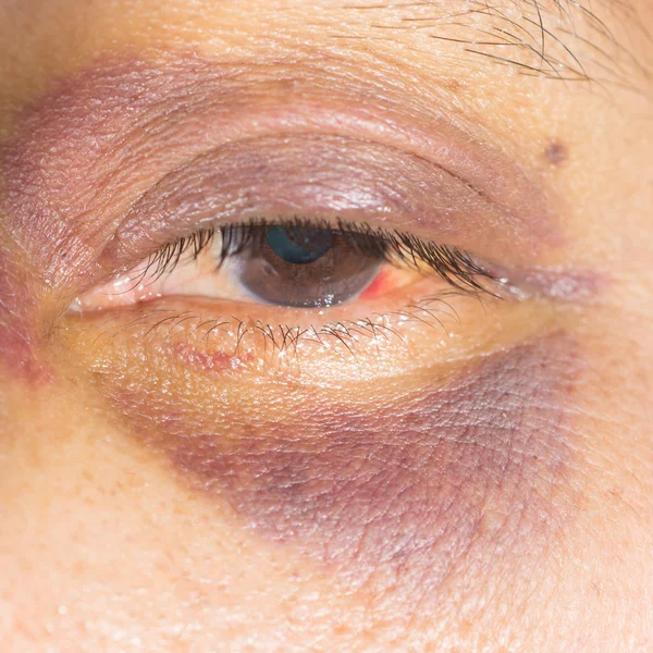 Equimosis fotos de stock, imágenes de Equimosis sin royalties ...