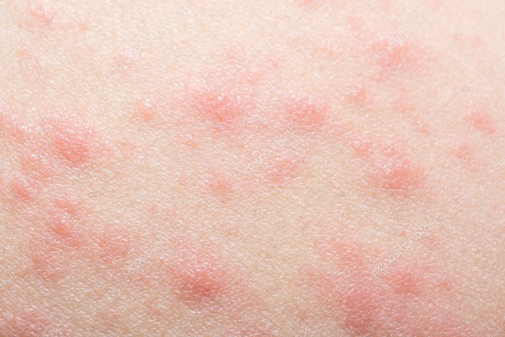 Vesicular rash Stock Photo by ©arztsamui 60480433