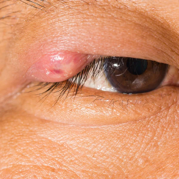 Eye lid abscess "stye" — Stock Photo © arztsamui #47171081
