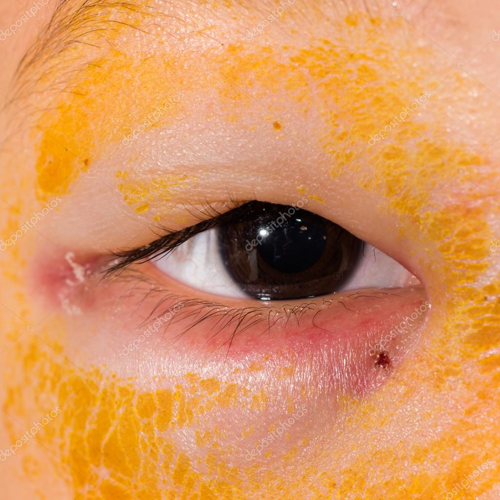 Equimosis Periorbitaria