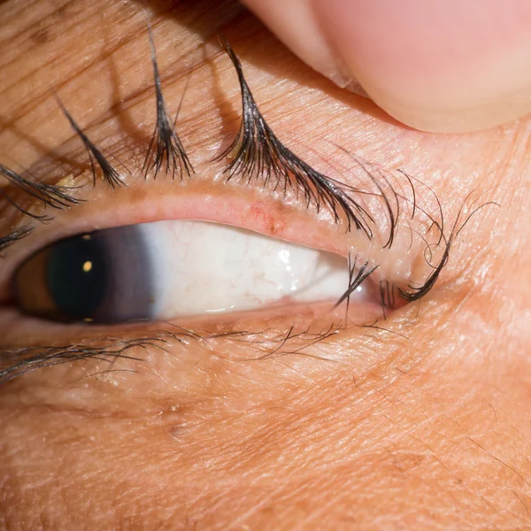 Trichiasis Stock Photos, Royalty Free Trichiasis Images | Depositphotos