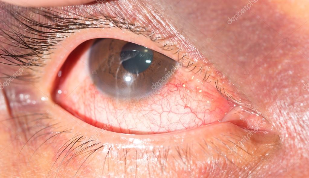 Periorbital Ecchymosis