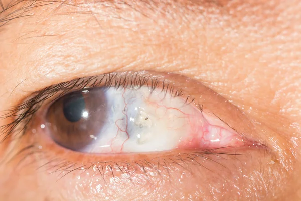 Acute anterior uveitis at eye test — Stock Photo © arztsamui #90112598