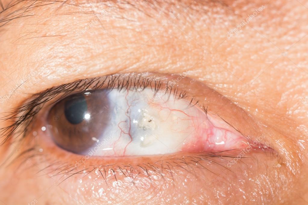 Scleral melting at eye test — Stock Photo © arztsamui #90112198