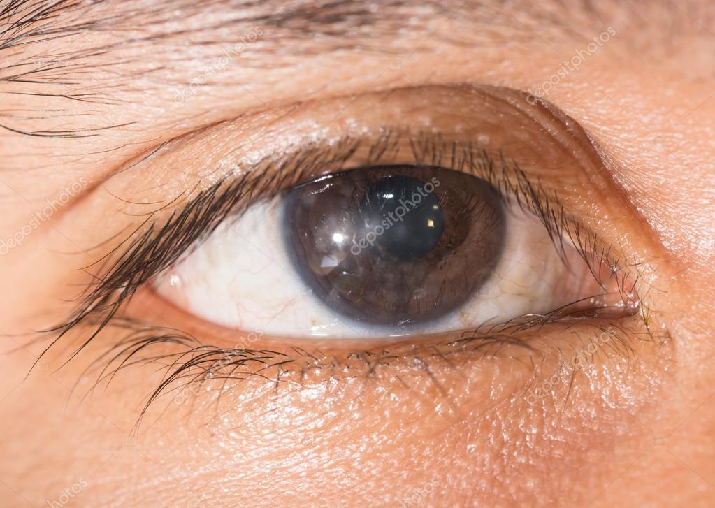 Queratite numular no teste ocular — Fotografia de stock © arztsamui ...