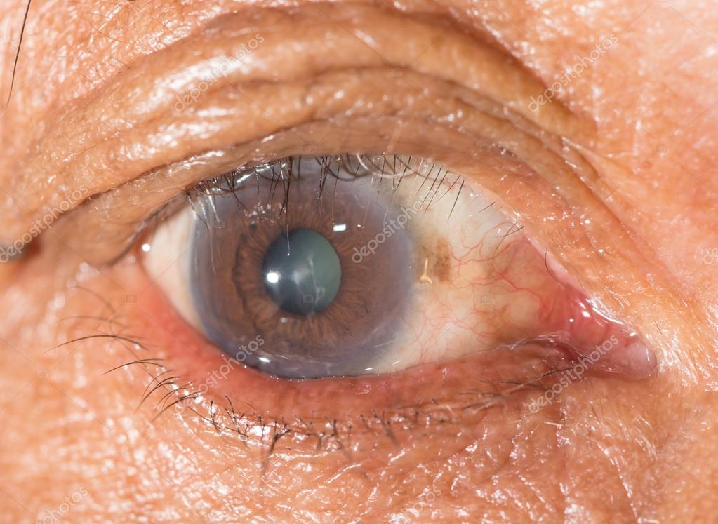 Trachoma at eye test Stock Photo by ©arztsamui 91457964