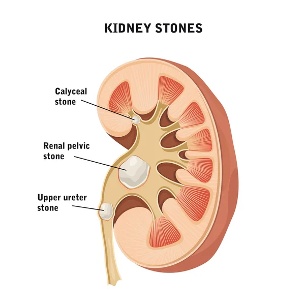 224 Kidney stone Stock Illustrations | Depositphotos