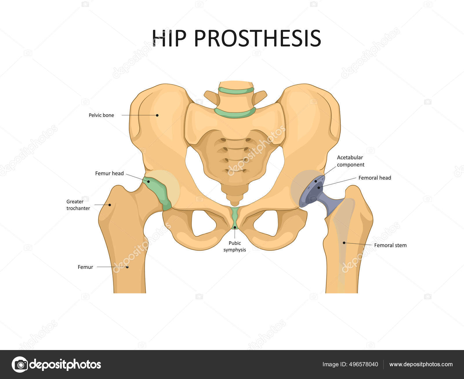 Lantion luuhun asennettu lonkan korvaava implantti. Lääketieteellinen ...