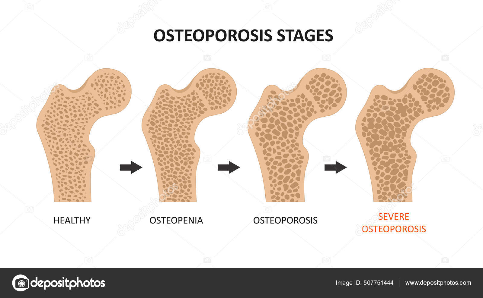 Osteoporose-Stadien. Schwammiger Knochenstrukturvektor, normal ...