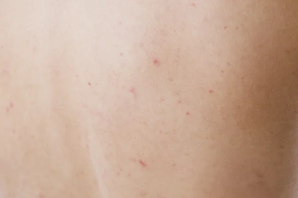 Itchy Pimple Rash On Back