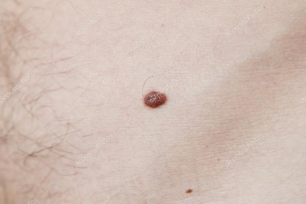 Birthmark on the human body close-up — Stock Photo © starast #60333063