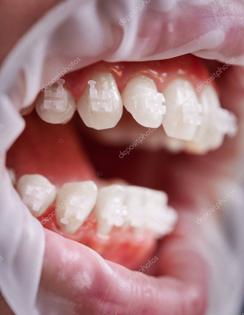 Primer plano de la persona con la boca abierta y dientes blancos con ...