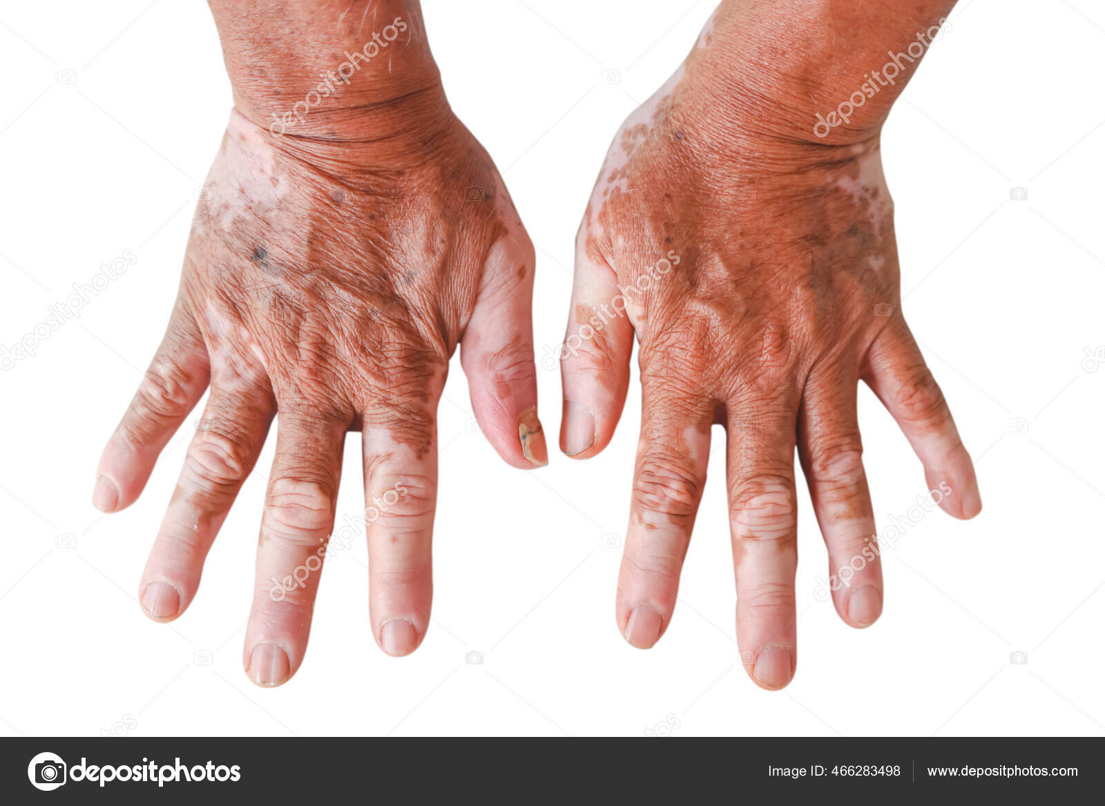 Close Vitiligo Skin Hands Old People Medical Condition Causing ...
