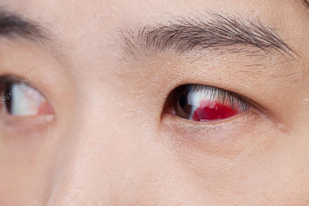 Gross Eye Injuries