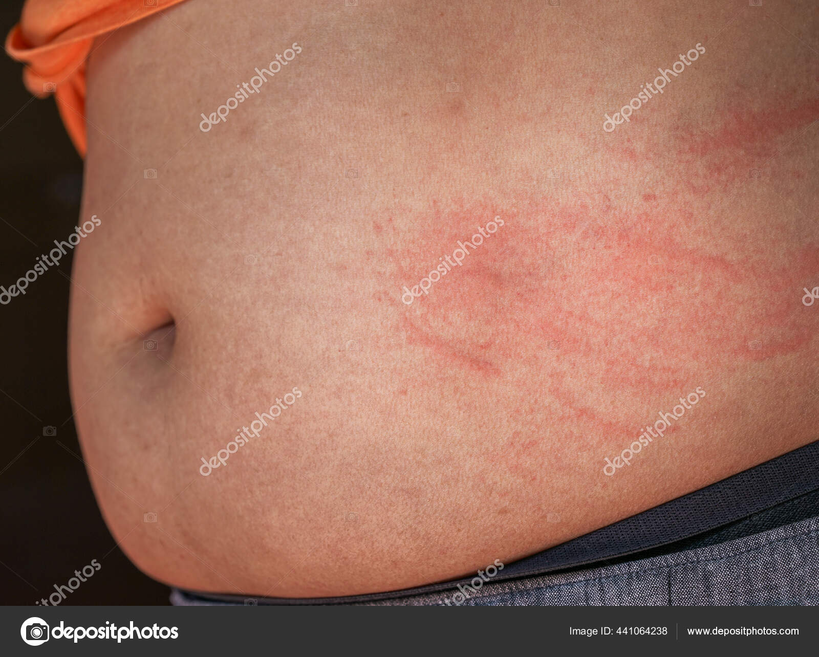 Scratching That Causes Welts