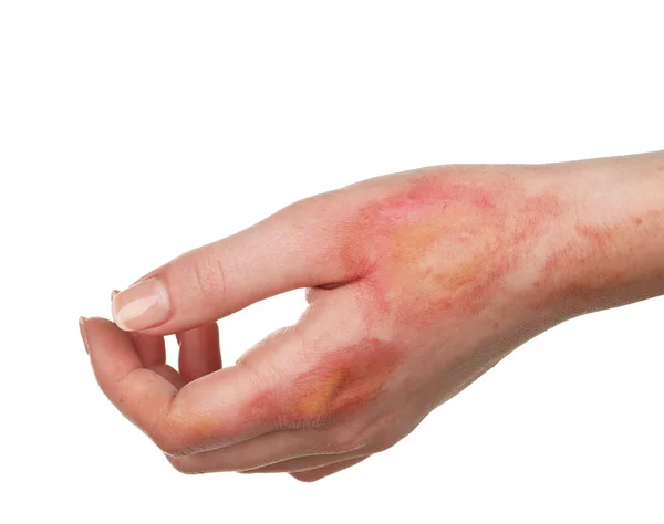 Burn injury Stock Photos, Royalty Free Burn injury Images | Depositphotos