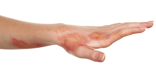 Stockfoto's van Brandwonden, rechtenvrije afbeeldingen van Brandwonden ...