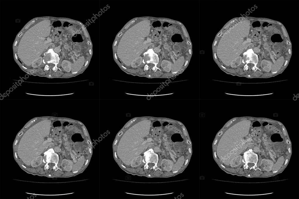 Tomografía computarizada de abdomen entero con contraste. Tomografía ...