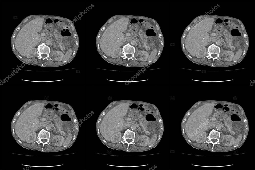 Tomografía computarizada de abdomen entero con contraste. Tomografía ...