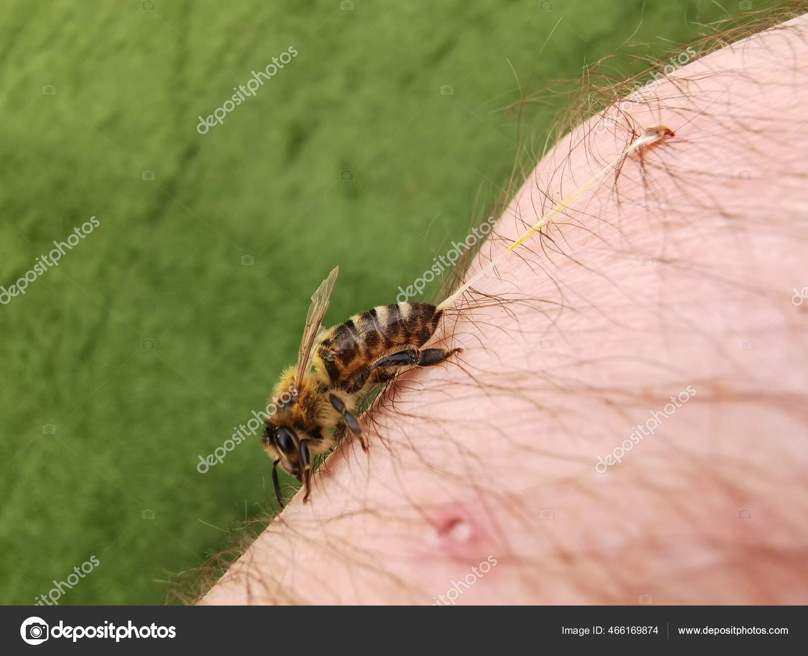 Treatment Bee Stings Apitherapy — Stock Photo © muro #466169874