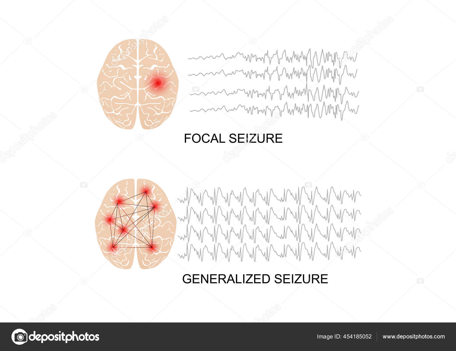 Ondas Cerebrales Convulsivas Epilepsia ScienceDirect