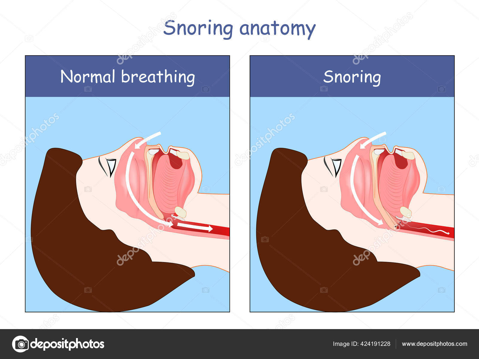 Snoring Anatomy Normal Breathing Snoring Air Open Obstructed Airways ...