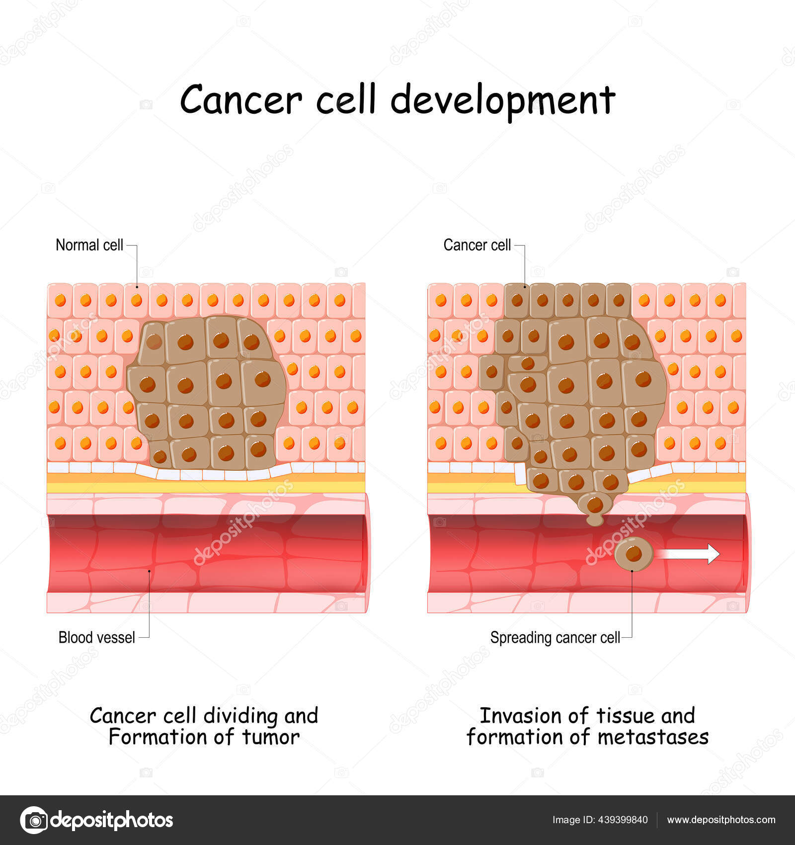 Cancer Development Diagram