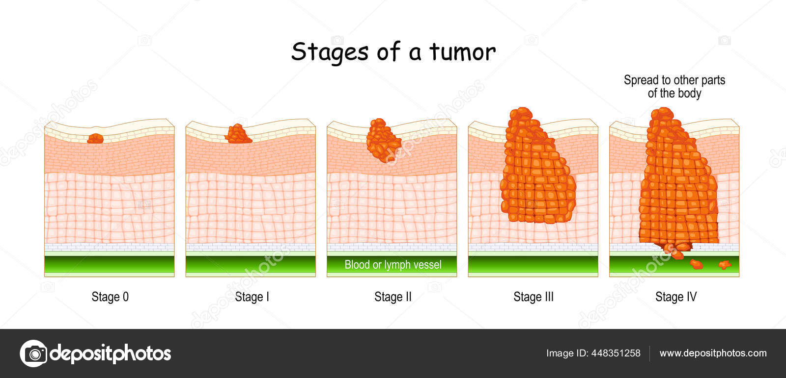Stades Cancer Classification Des Tumeurs Malignes Système Qui Est Couramment image vectorielle ...