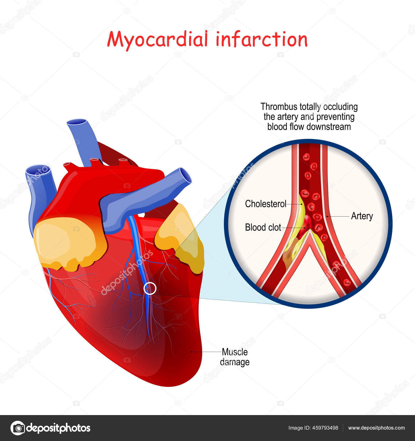 Myocardial Infarction Heart Attack Thrombus Totally Occluding Artery ...