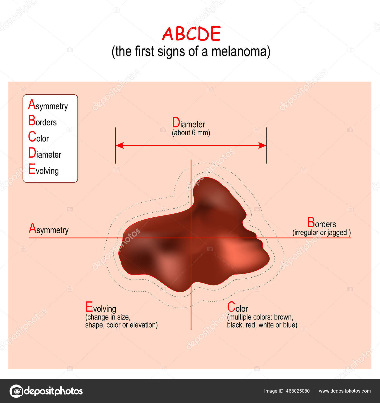 Regla Abcde Para Detección Precoz Del Melanoma Signos Síntomas Del Vector de stock por ...