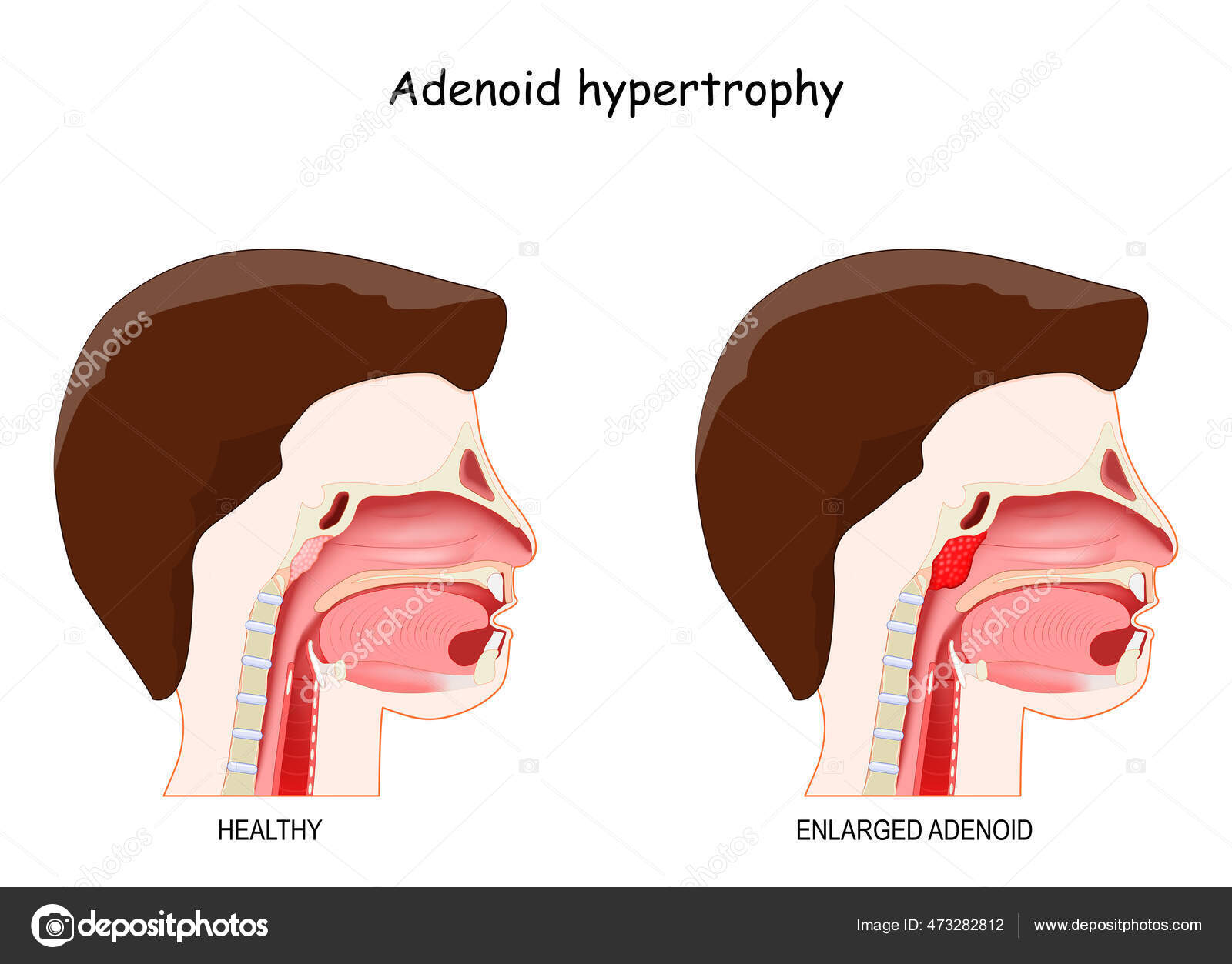 Adenoidectomy Anatomy