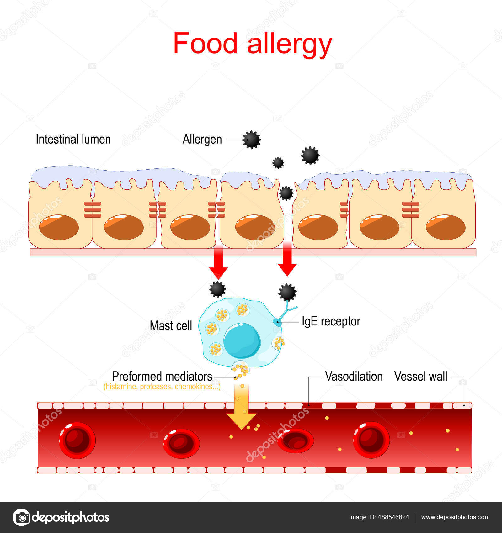 Matallergi Och Läckande Tarm Onormalt Immunsvar Mot Mat ...