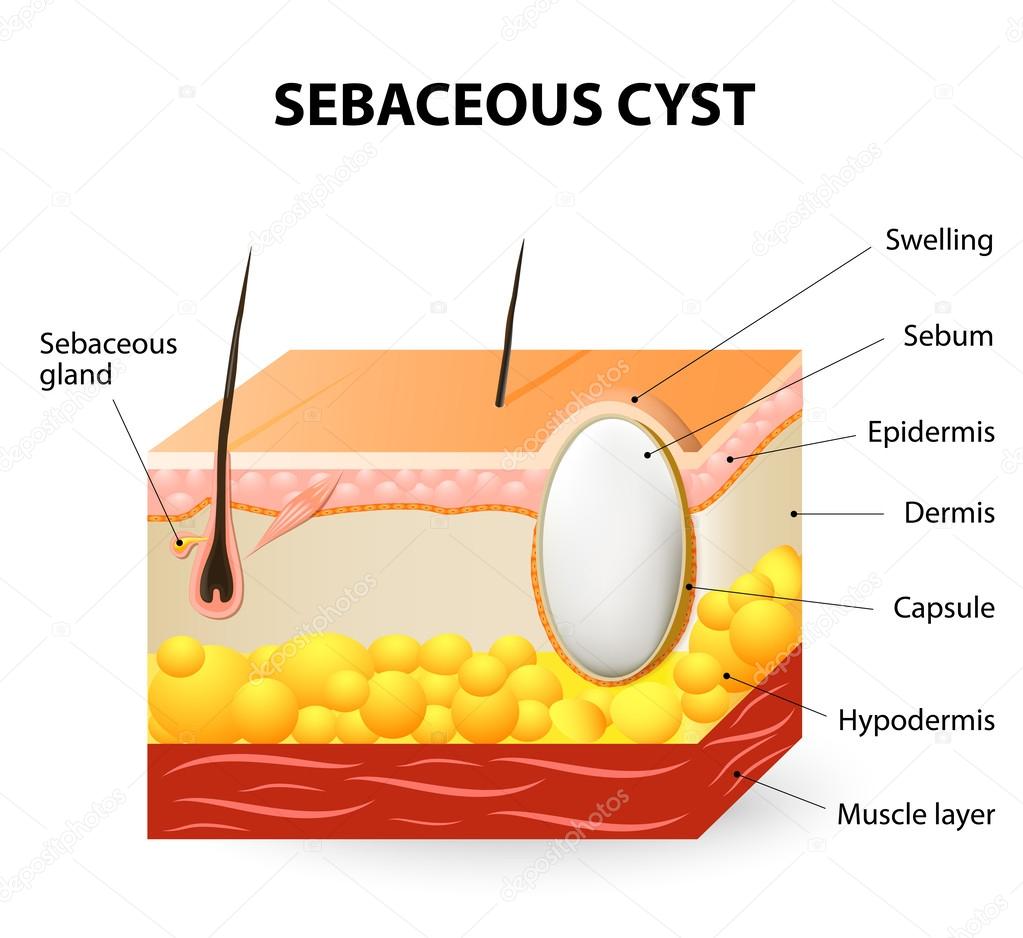 Kyste sébacé ou kyste trichilemmal — Image vectorielle edesignua ...