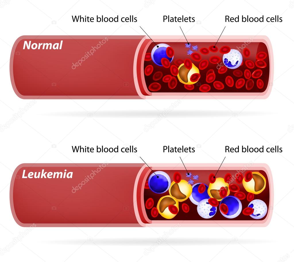 Cancer. Leukemia or leukaemia ⬇ Vector Image by © edesignua | Vector ...
