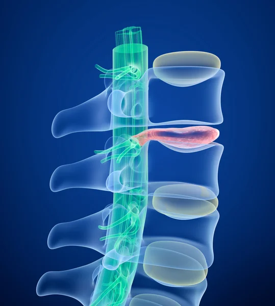 Spinal cord under pressure of bulging disc, X-Ray view. 3D rendering ...