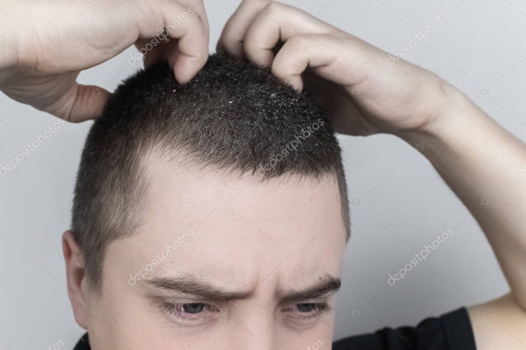 Caspa en el hombro de un hombre. Vista lateral de un hombre que tiene ...