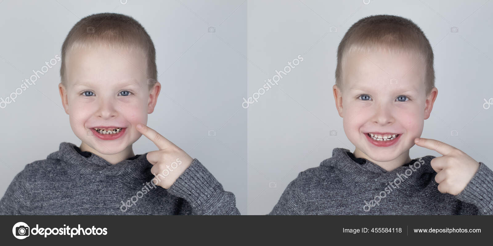 Child Shows Damaged Teeth Caries Second Picture Dentist's Work ...