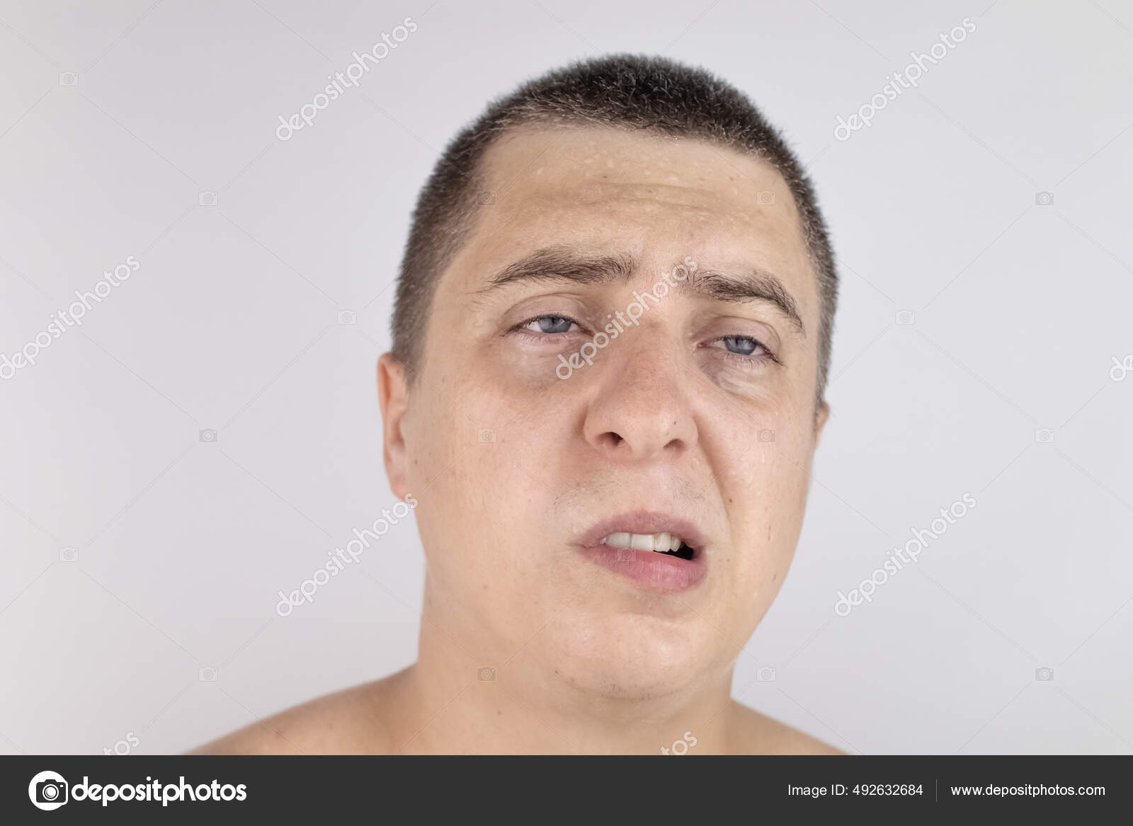 Man Sweating His Face Looking Camera Sweat Gland Problems Hyperhidrosis ...