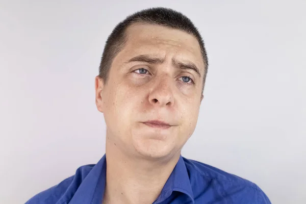 A man with sweating on his face is looking at the camera. Sweat gland ...