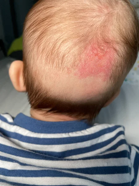 Seborrheic dermatitis face Stock Photos, Royalty Free Seborrheic ...