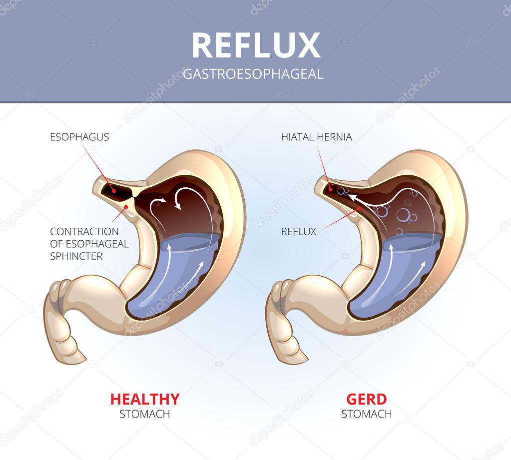 Enfermedad Por Reflujo Gastroesofágico Estómago Sano Y Enfermo Vector