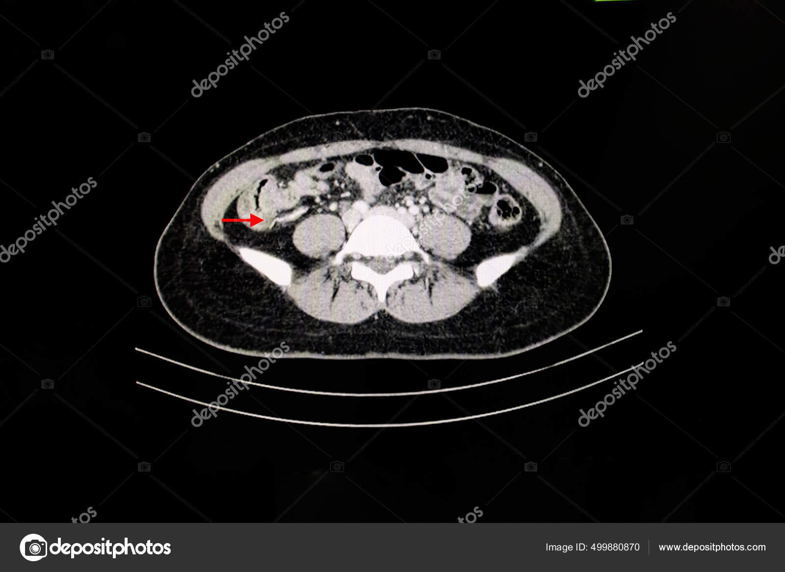 Scan Abdomen Patient Abdominal Pain Showing Swollen Appendix Suggesting ...
