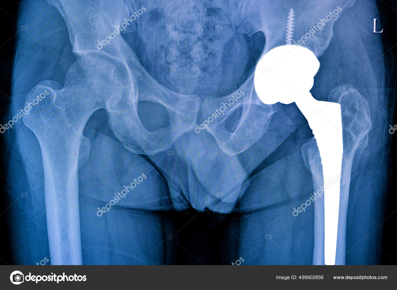 Titanium Joint Replacement