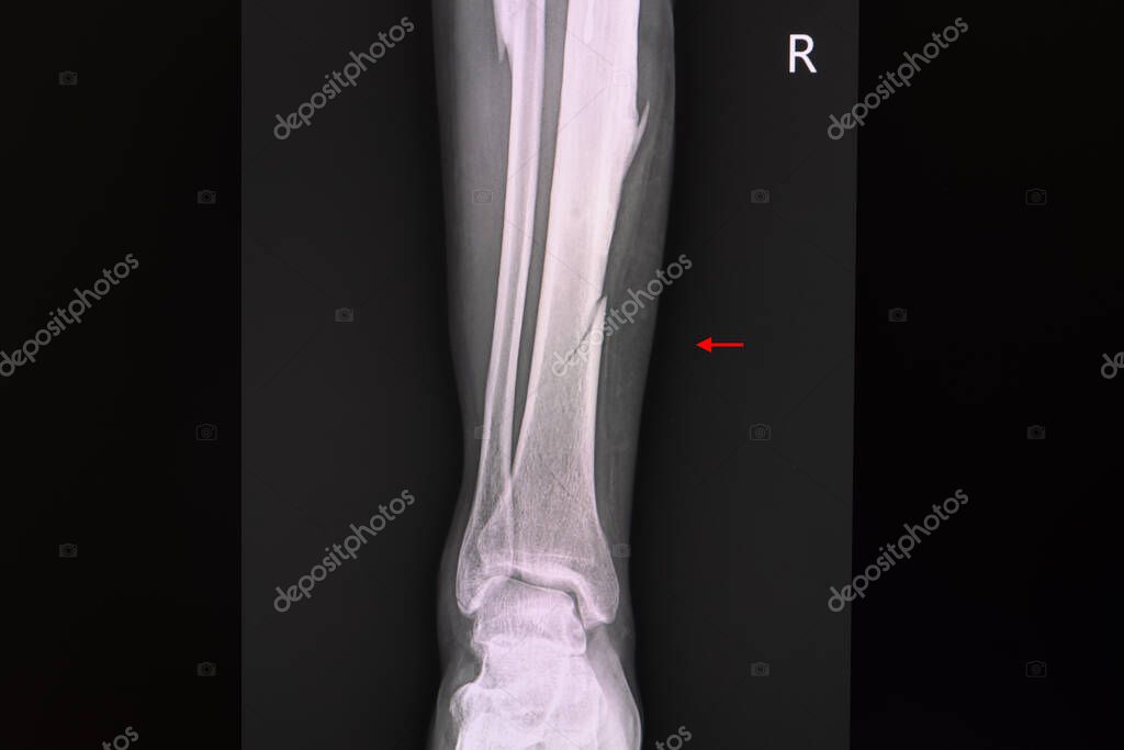 Radiografía de un paciente con fractura espiral cerrada no desplazada ...