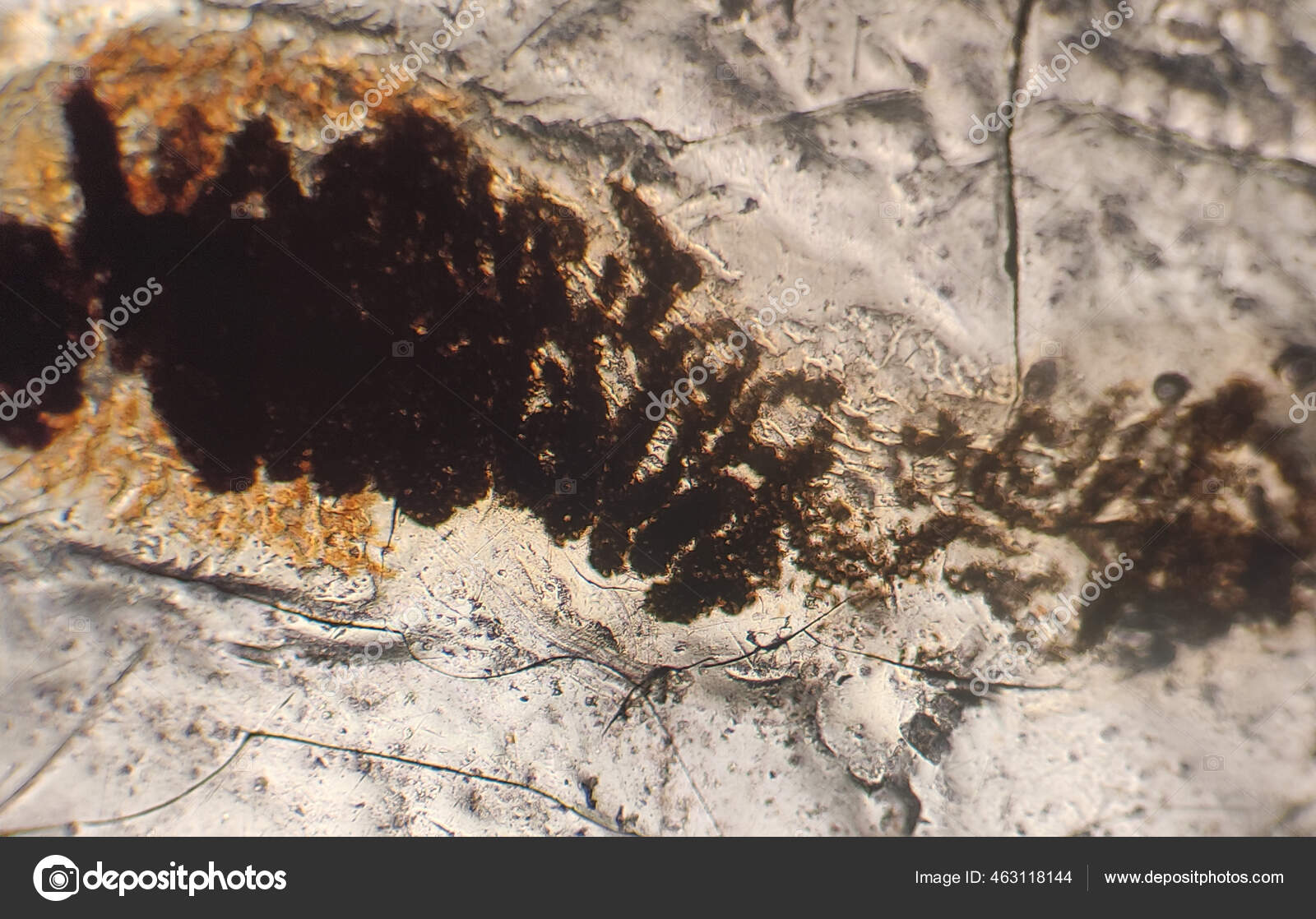 Œufs de vers de pin Enterobius vermicularis à l'examen microscopique ...