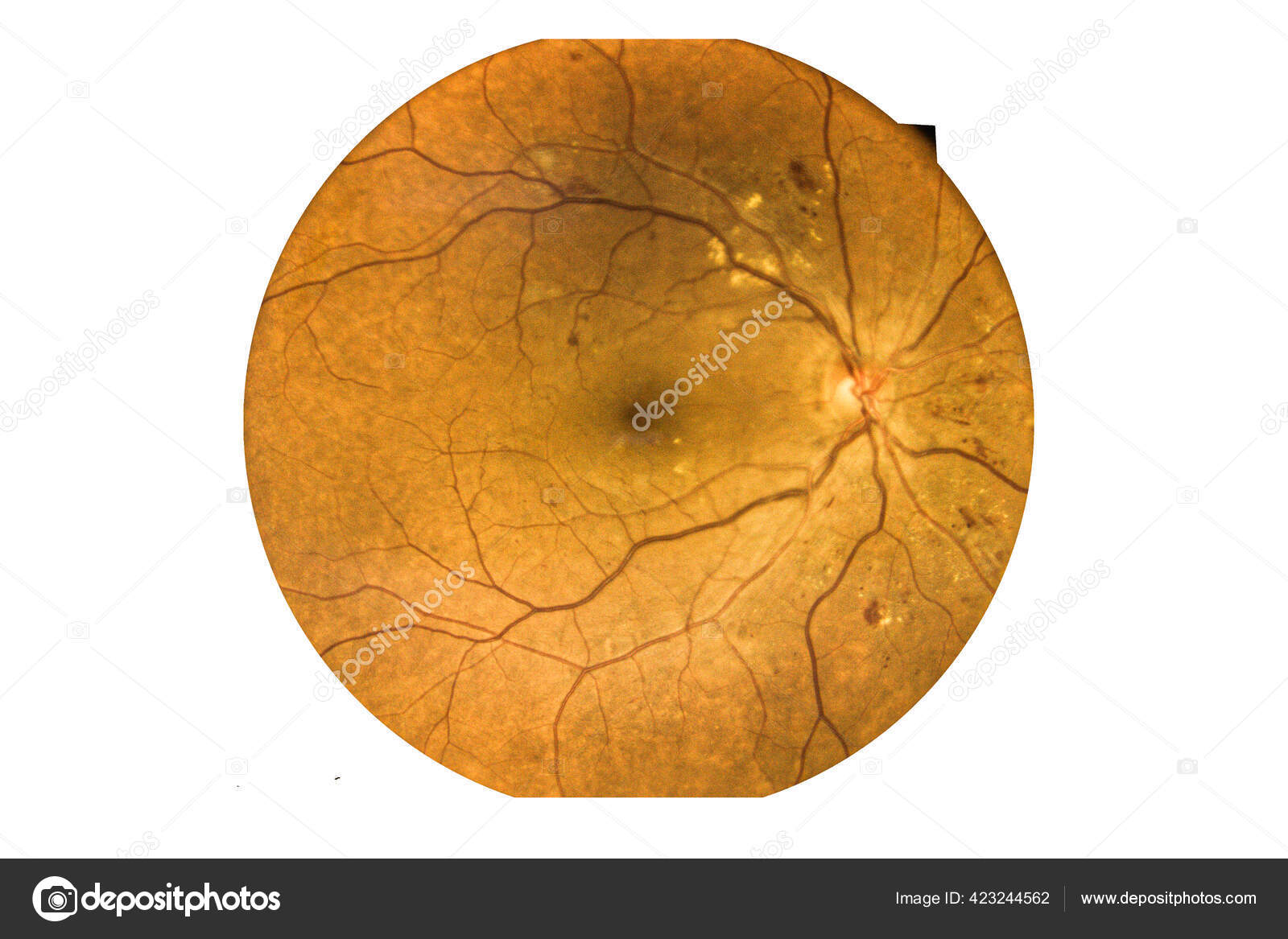 Fundus Photography Madical Retina Abnormal Isolated White Background ...